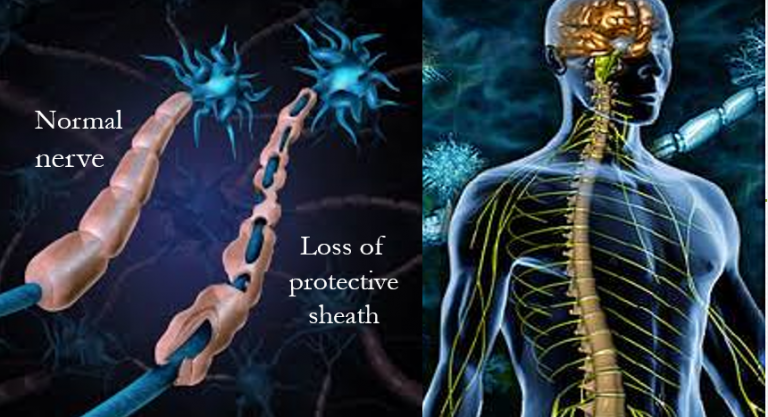 Multiple Sclerosis Understanding and Health Measures