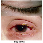 Swollen Eyelid - Know the causes, remedies and alert signs