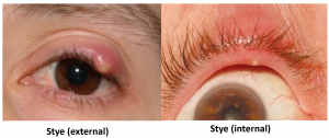 Swollen Eyelid - Know the causes, remedies and alert signs