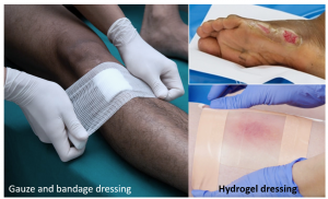 Skin Ulcers & Wound: Causes, Types, Treatment & Symptoms