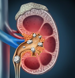 5 Types of Urinary Stones - How to Diagnose and Treat