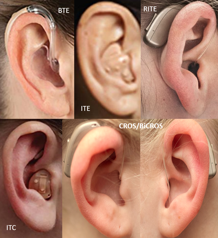 Hearing Loss – 5 Important Points of Awareness and Understanding